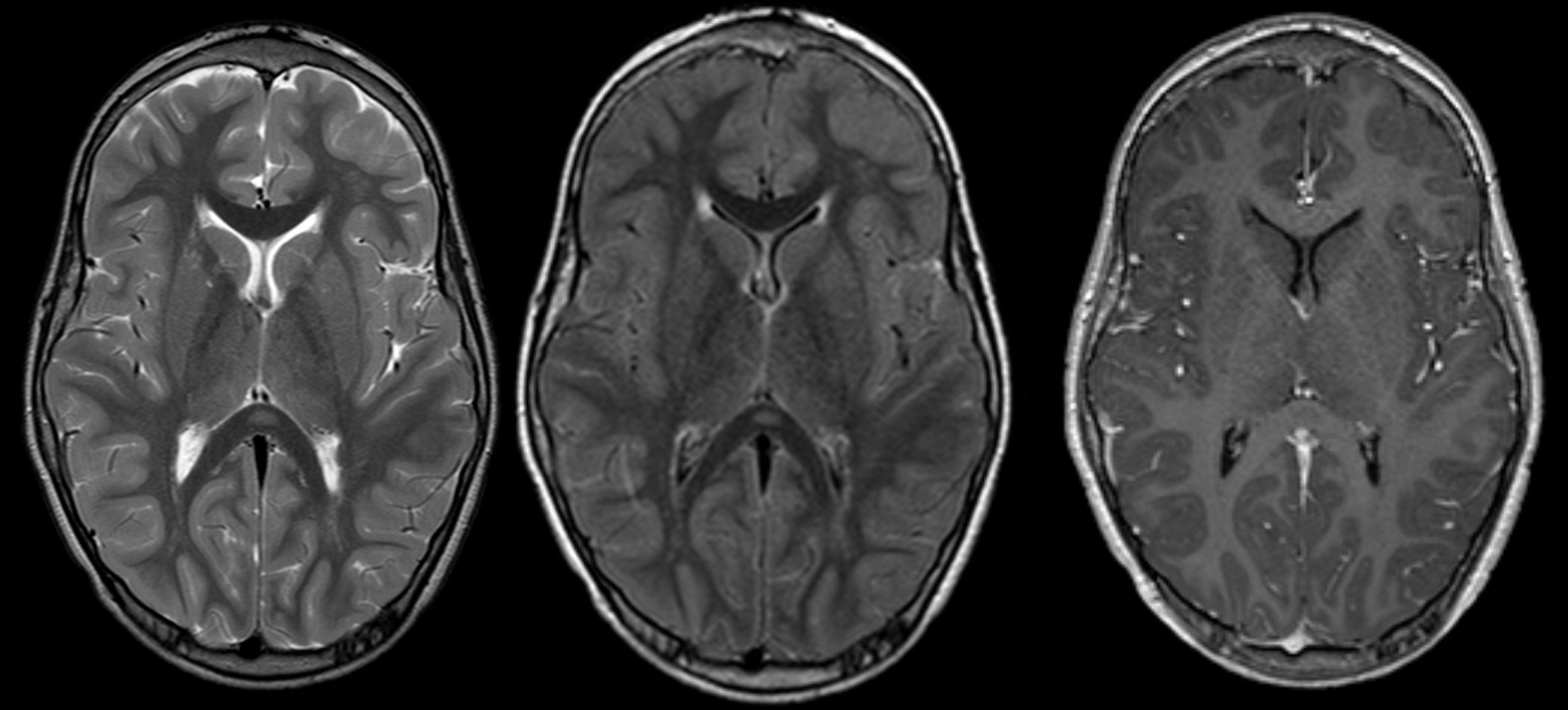 Ce programme informatique parvient à localiser des tumeurs cérébrales ...